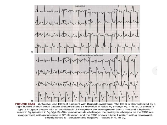 Cardiac Channelopathies atul.pptx