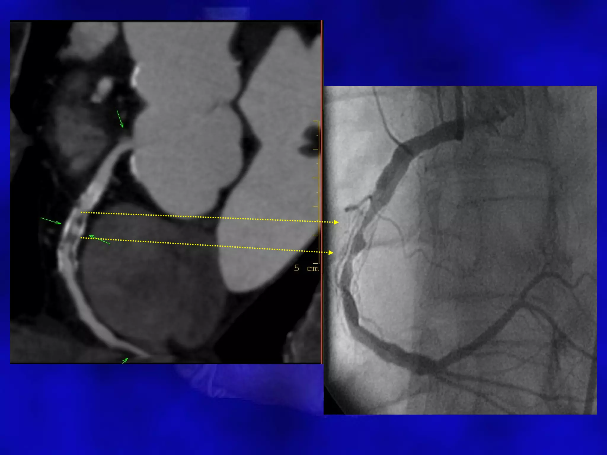 Cardiac ct ccta | PPT