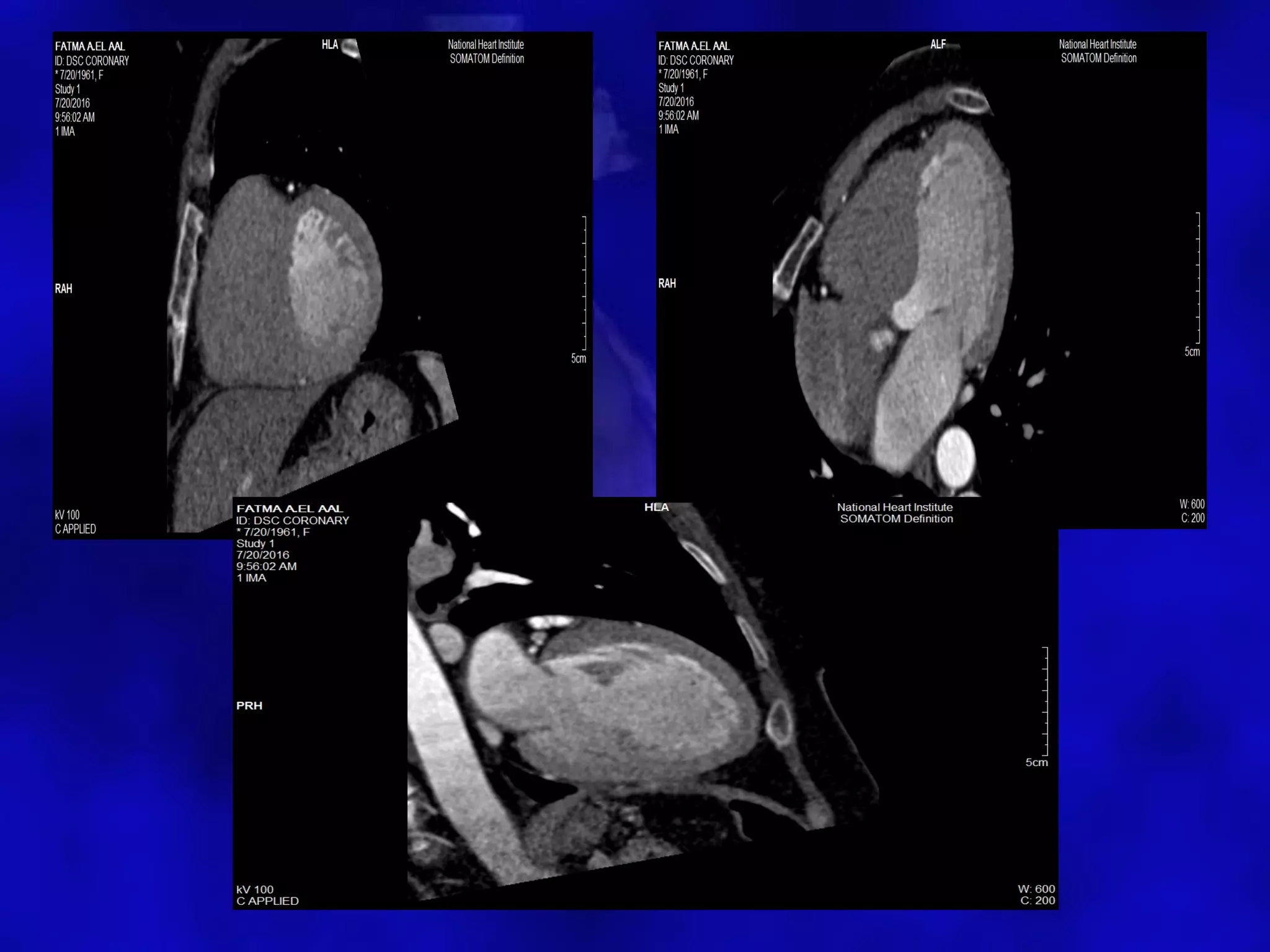 Cardiac ct ccta | PPT | Heart and Cardiovascular Diseases | Diseases ...