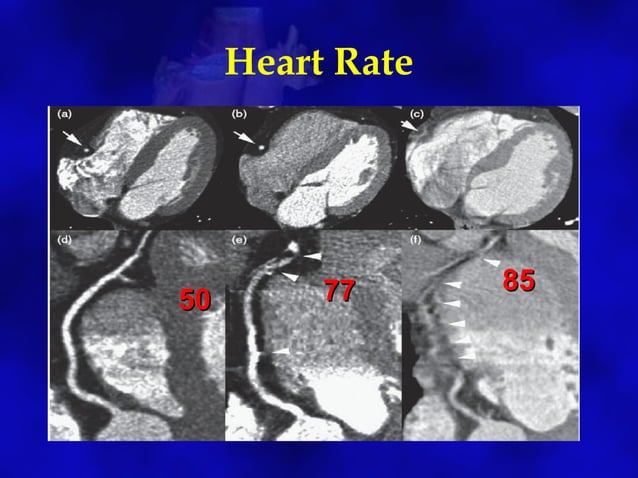 Cardiac ct ccta | PPT | Heart and Cardiovascular Diseases | Diseases ...