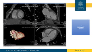 CARDIAC CT ANATOMY Book Reading Rahmat Muliawan | PPTX