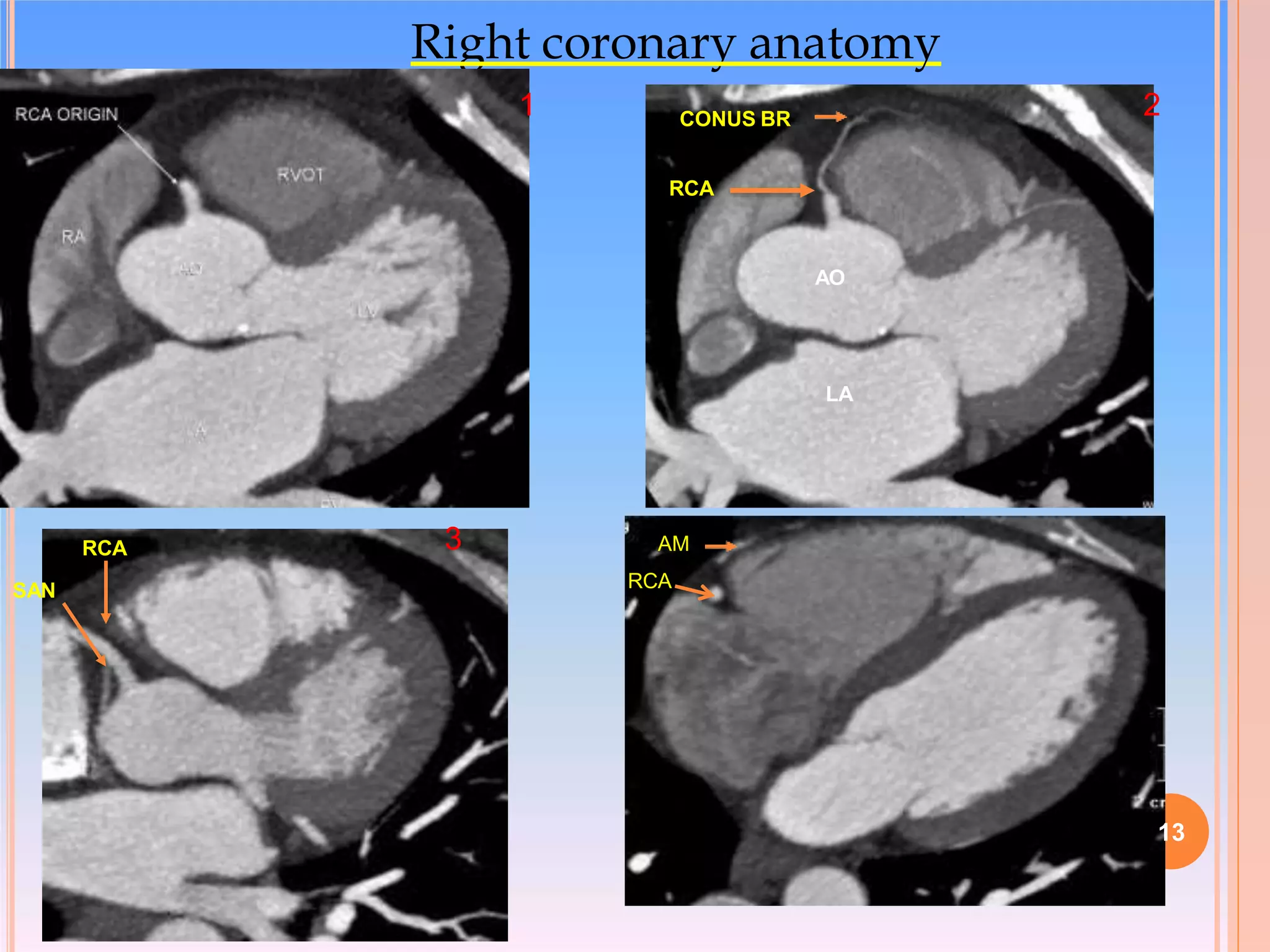 Coronary CT Angiography | PPTX