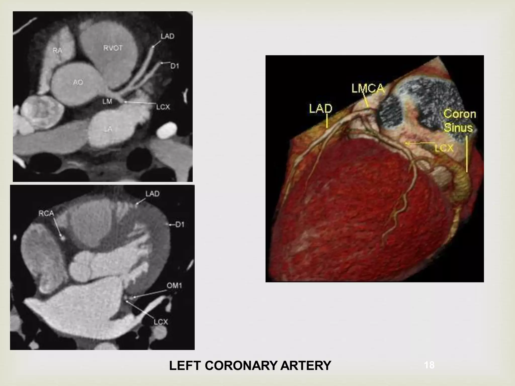 Coronary CT Angiography | PPTX