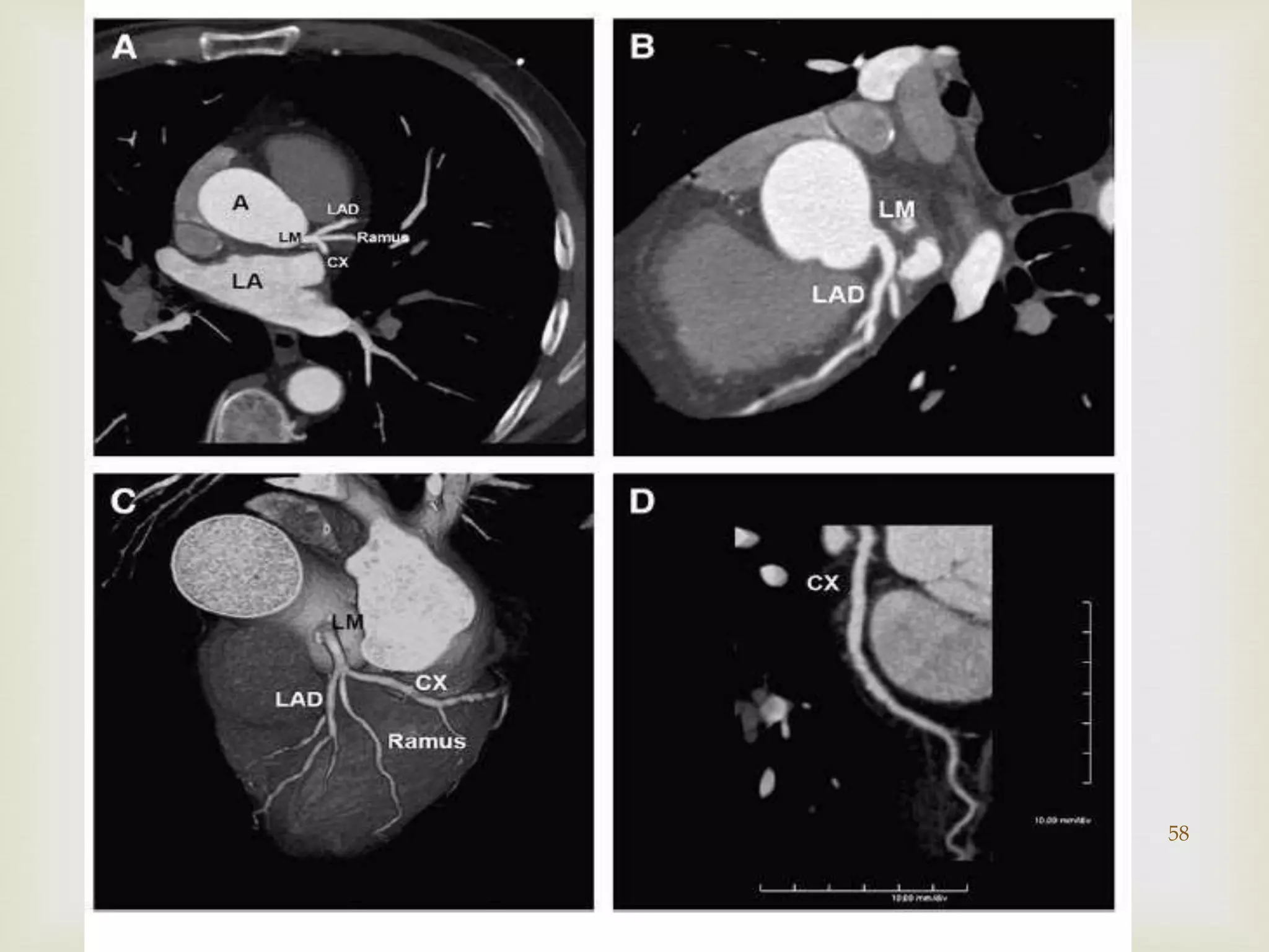 Coronary CT Angiography | PPTX