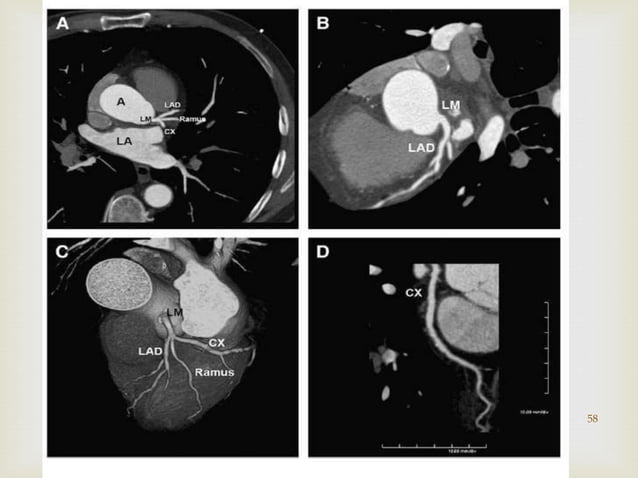 Coronary CT Angiography | PPTX