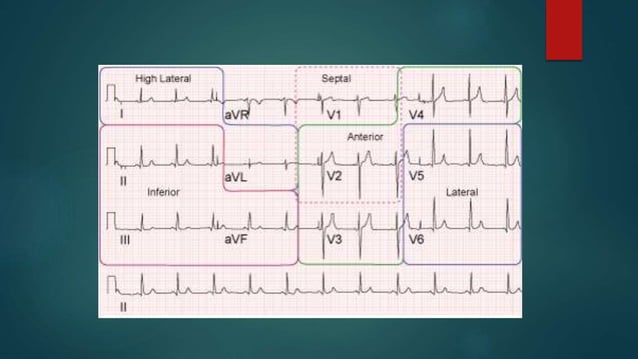 Cardiac cycle ecgs__murmurs | PPT