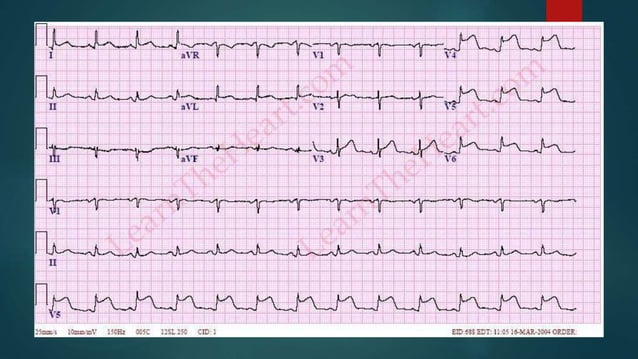 Cardiac cycle ecgs__murmurs | PPT
