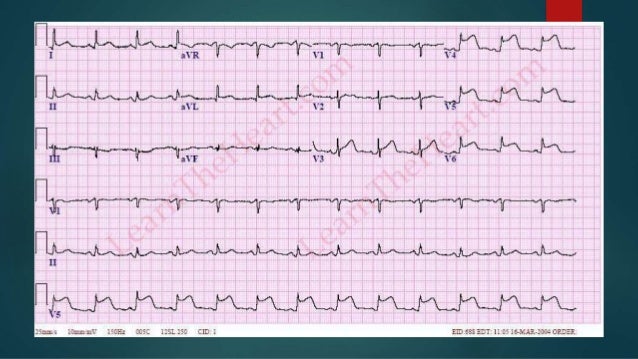 Cardiac cycle ecgs__murmurs