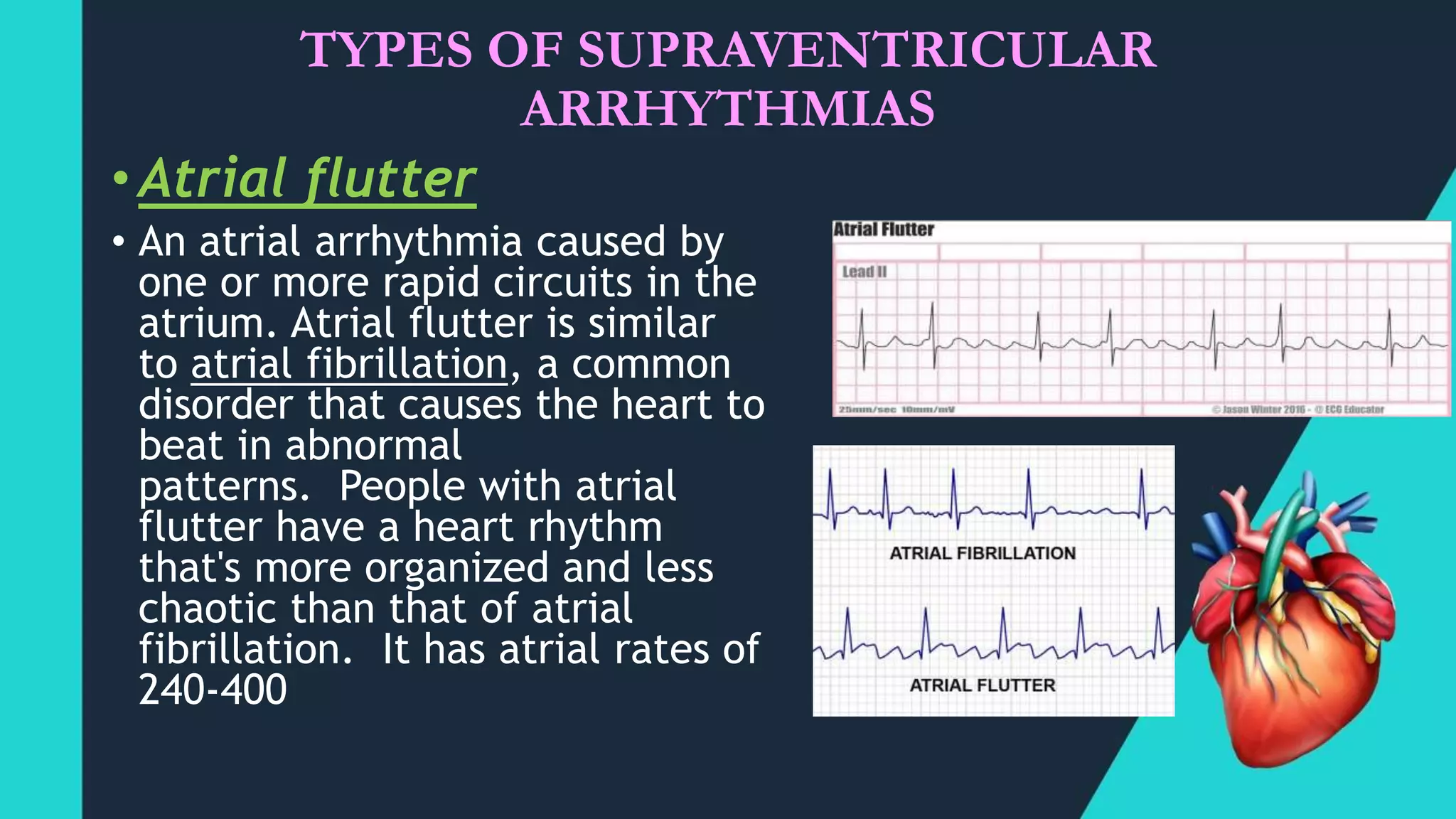 Cardiac dysrhythmias | PPTX