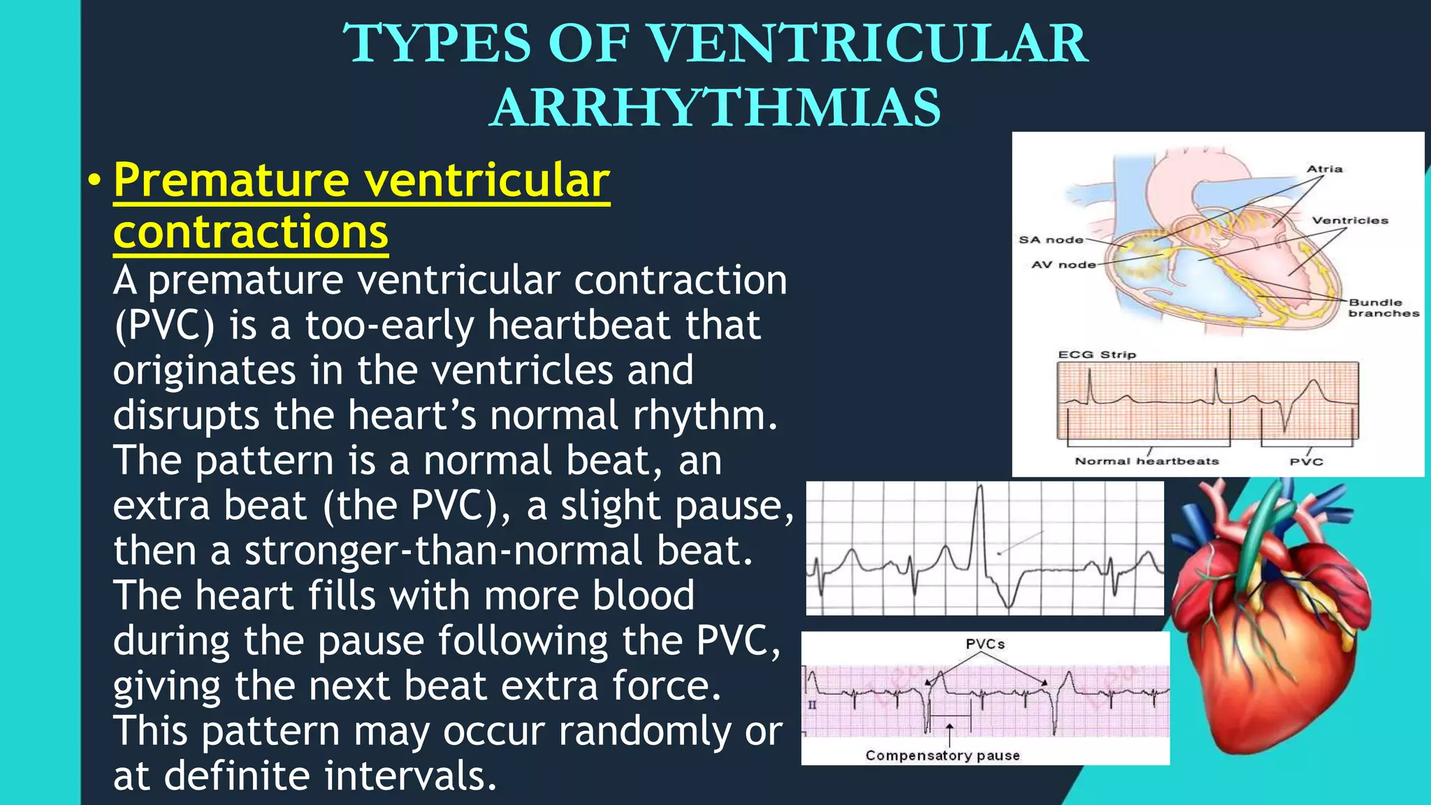 Cardiac dysrhythmias | PPTX
