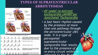 Cardiac dysrhythmias | PPTX