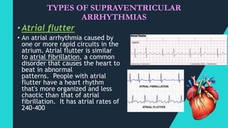 Cardiac dysrhythmias | PPTX