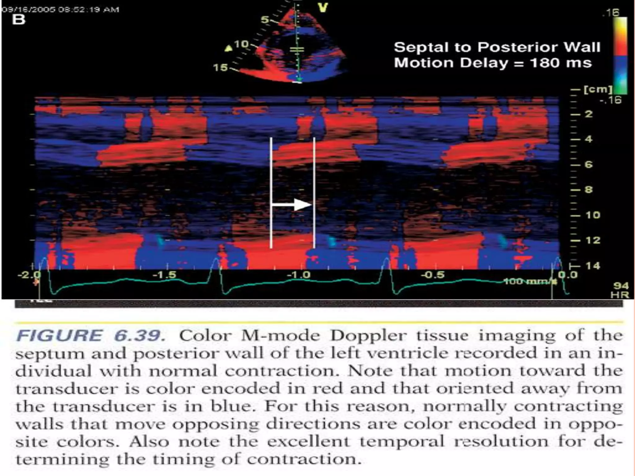 Cardiac dyssynchrony ppt by dr awadhesh | PPTX