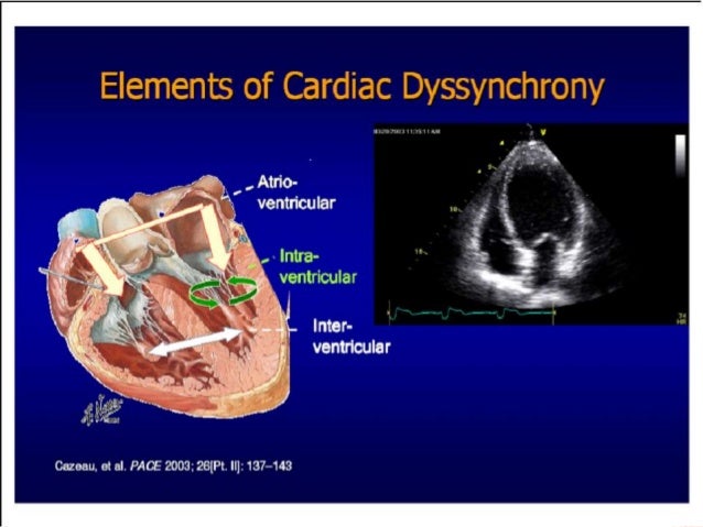 Cardiac dyssynchrony ppt by dr awadhesh