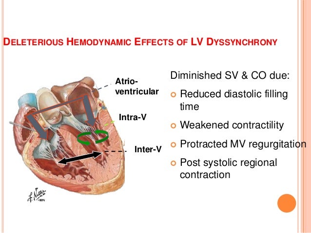 Cardiac dyssynchrony ppt by dr awadhesh