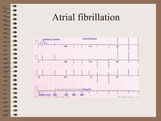 Cardiac Ecg Interpretation | PDF