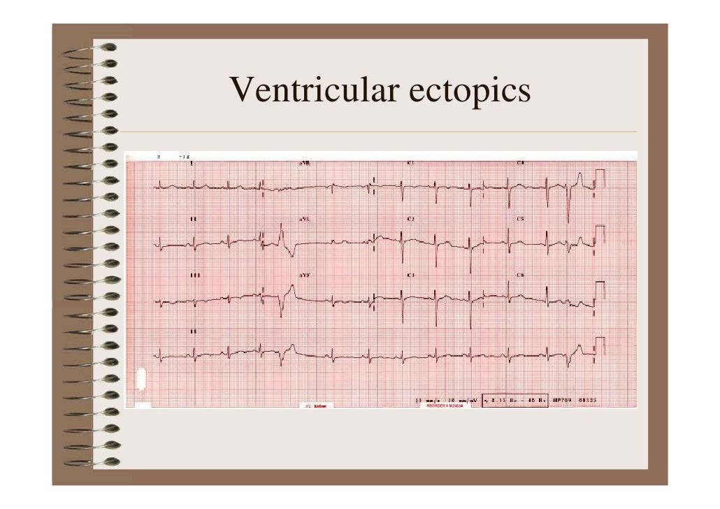 Cardiac Ecg Interpretation