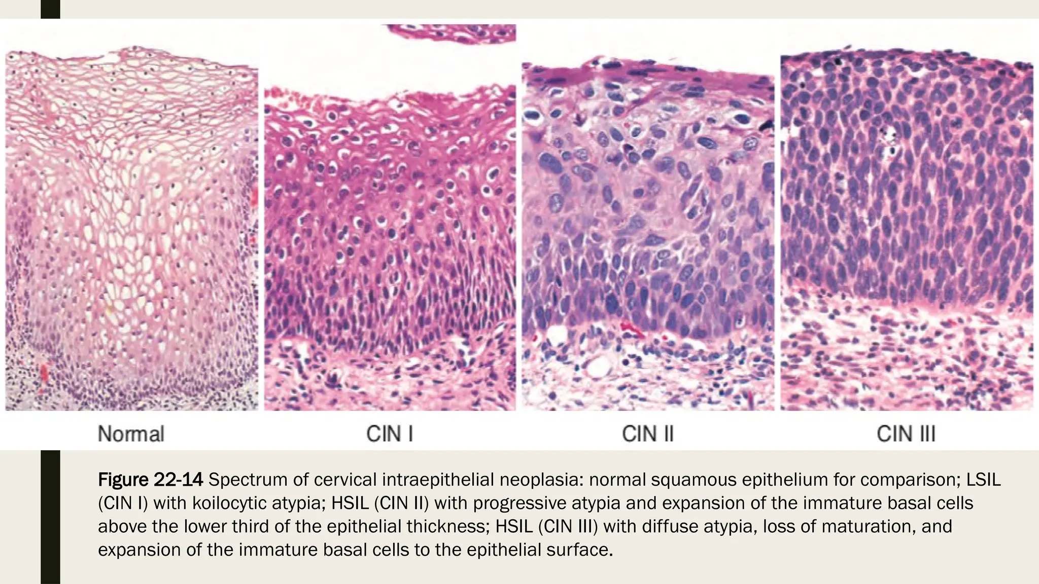 cardiac hypertrophy & CIN dysplasia metaplasia .pptx
