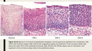 cardiac hypertrophy & CIN dysplasia metaplasia .pptx