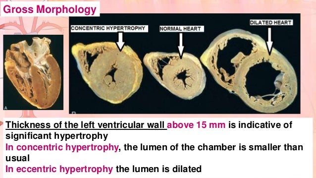 Cardiac hyprtrophy and heart failure