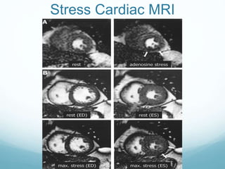Cardiac investigations for acute coronary syndrome | PPTX