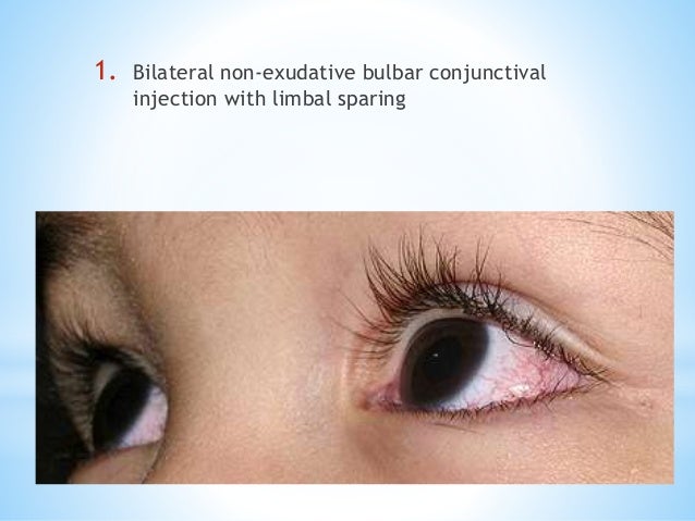 Limbic Sparing Conjunctivitis Diagnosis, Management, And Treatment Of