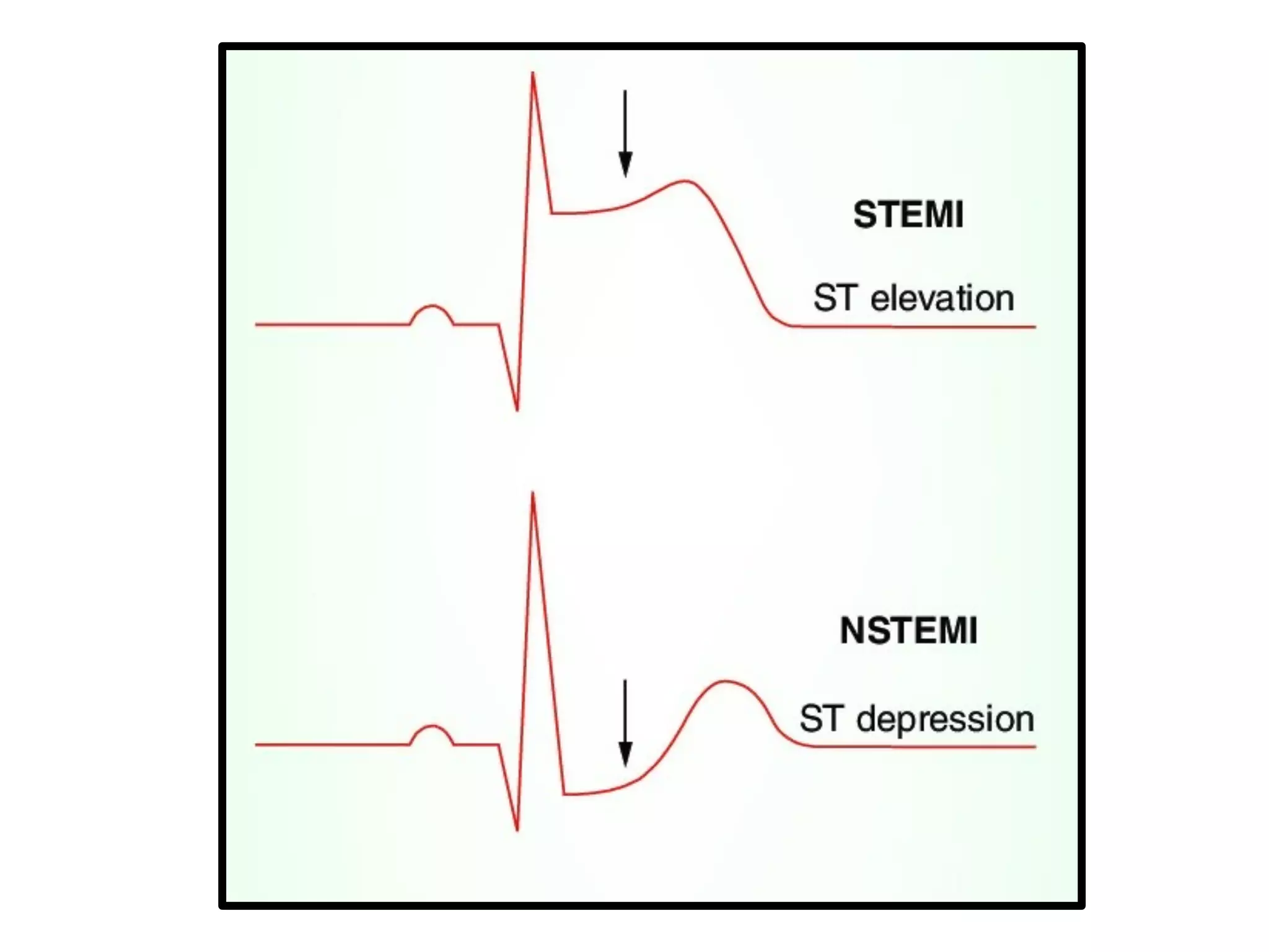 Cardiac markers | PDF