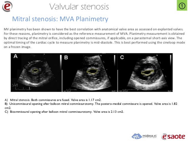 Cardiac Measurements Guidelines | powered by Esaote