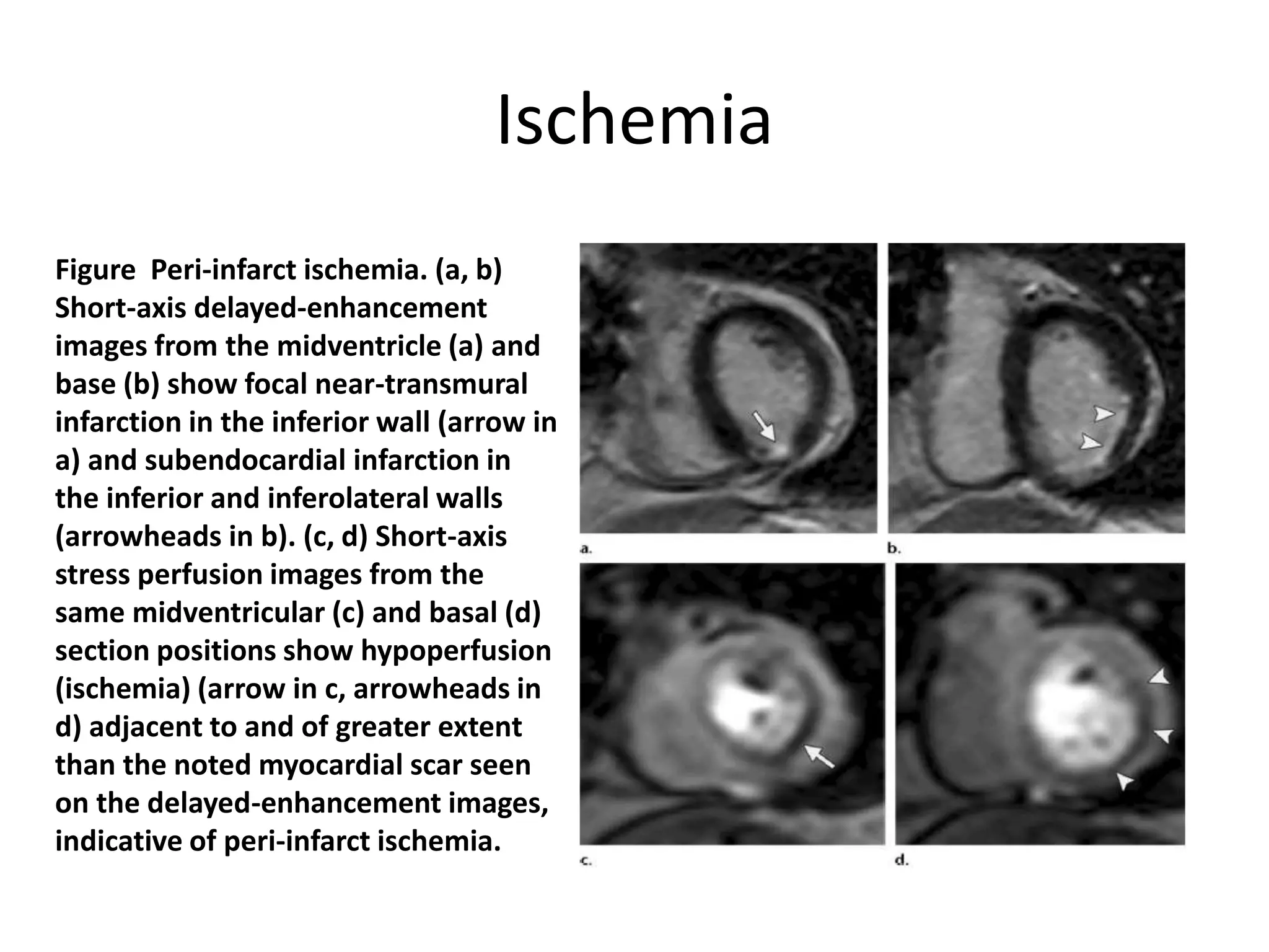 Cardiac MRI | PPT