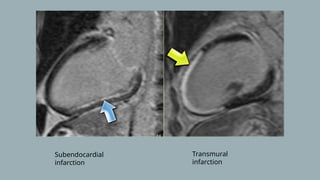 Cardiac MRI .pptxbbbbbbbbbbhhhhhhhhjhjjjjj | PPT
