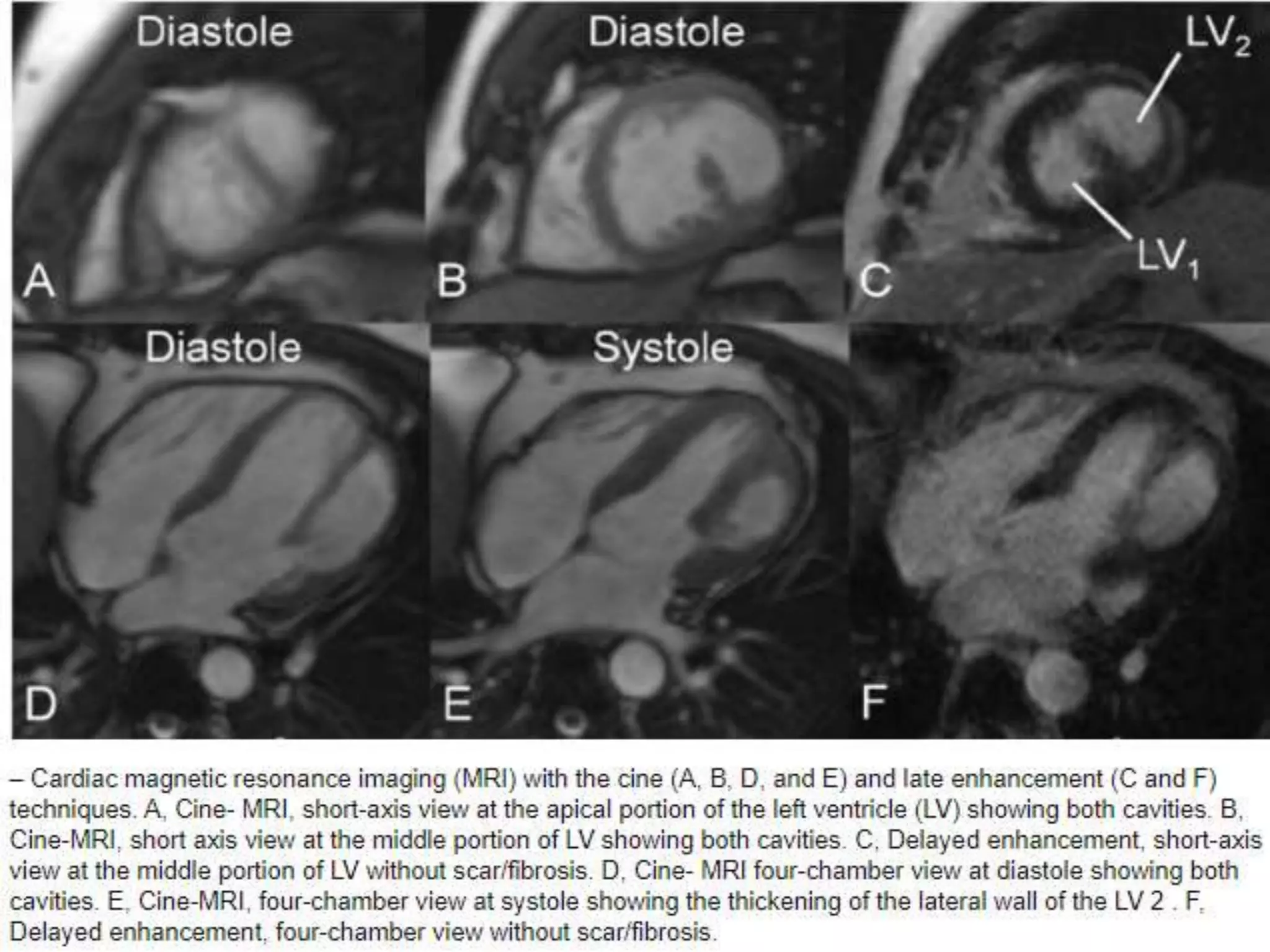 Cardiac MRI basics | PPTX