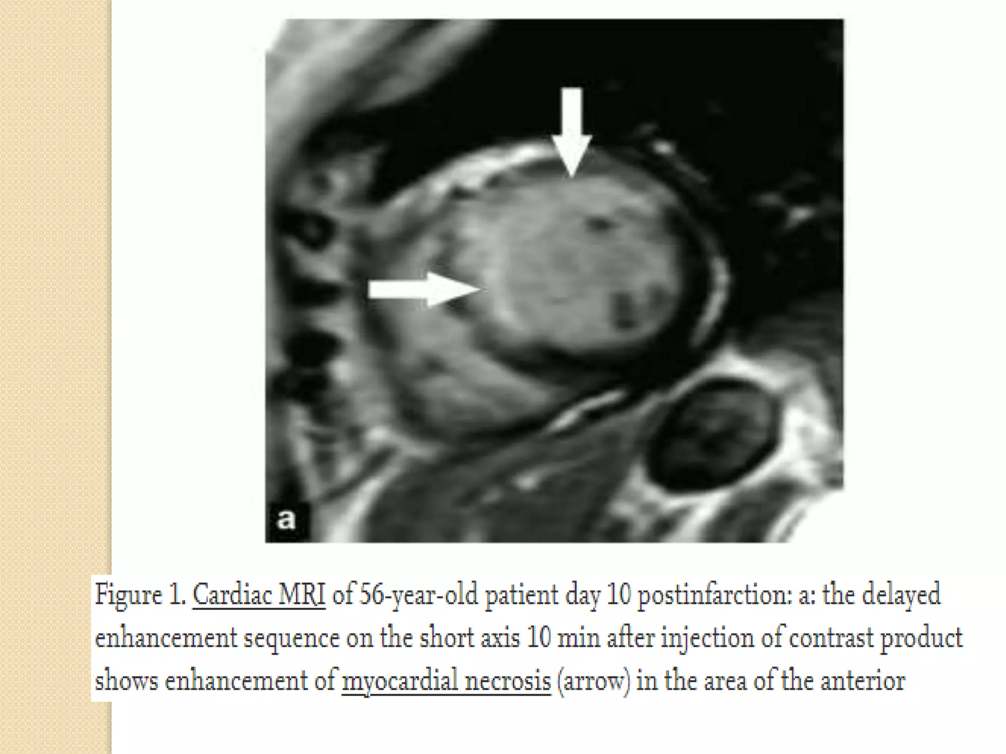 Cardiac MRI basics | PPTX