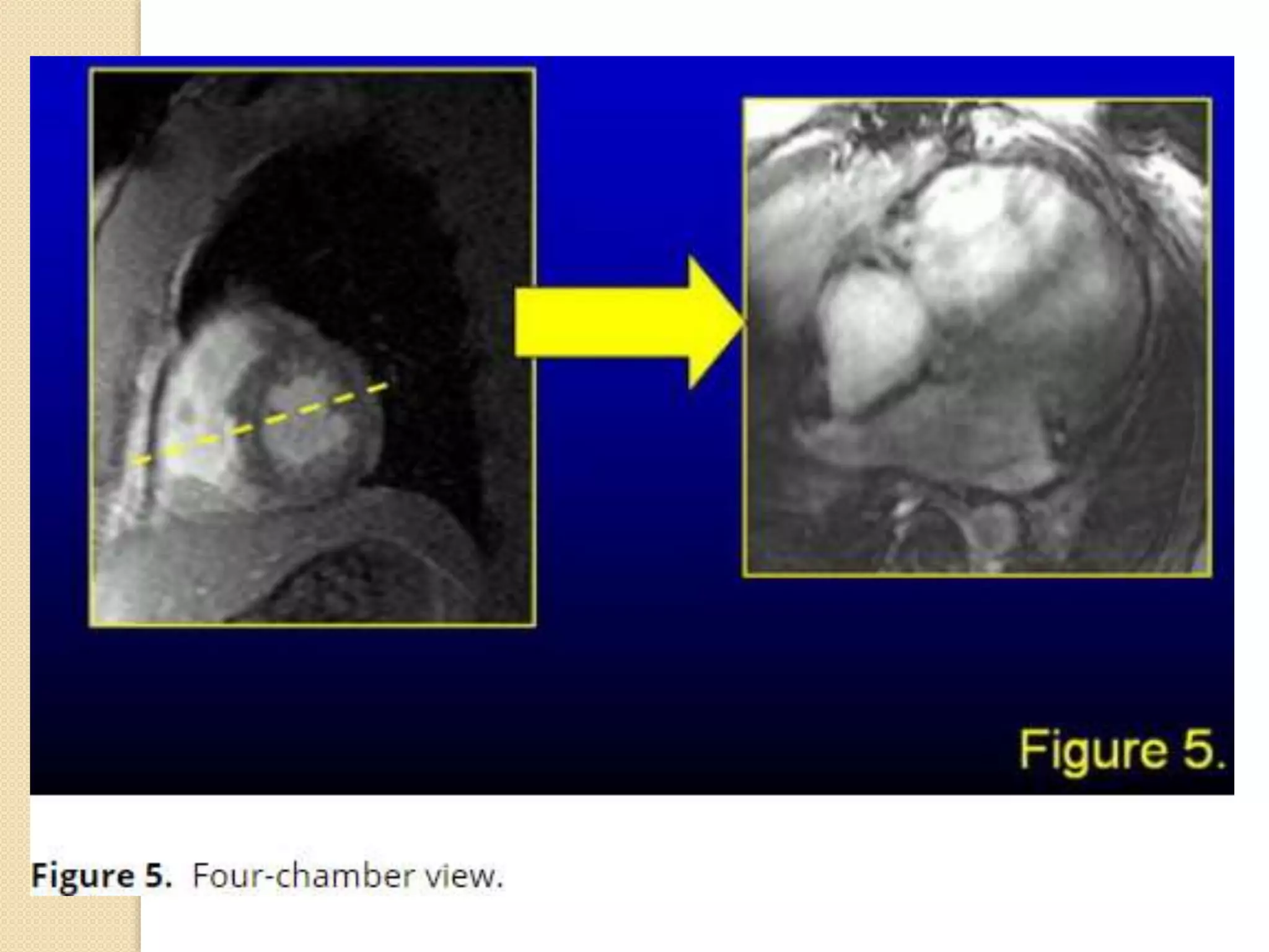 Cardiac MRI basics | PPTX