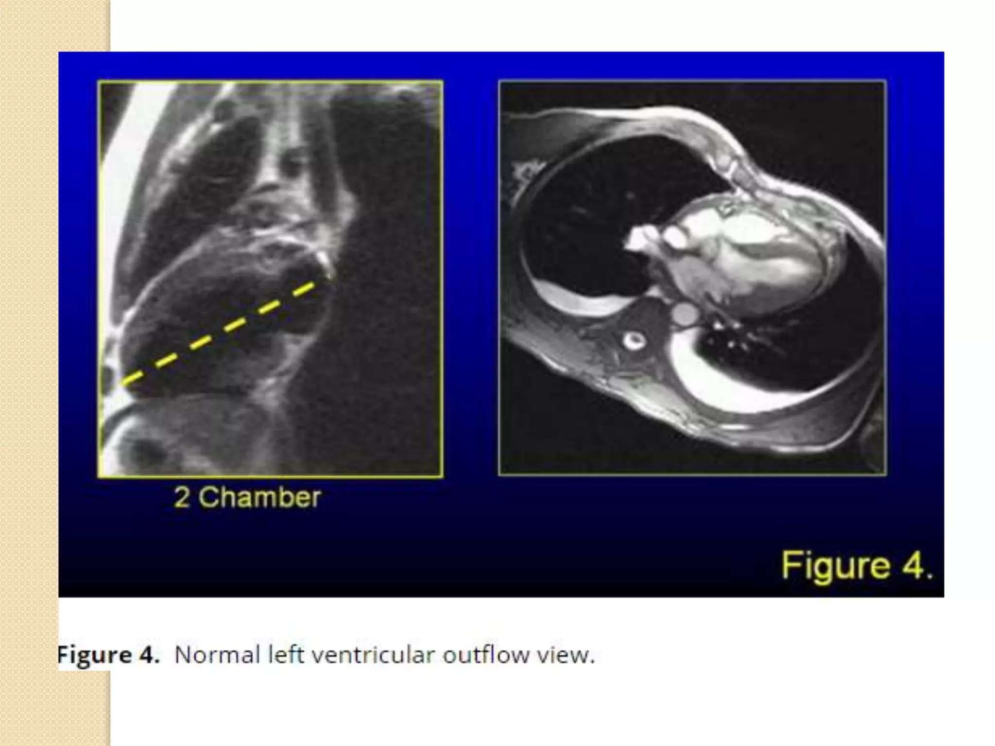 Cardiac MRI basics | PPTX