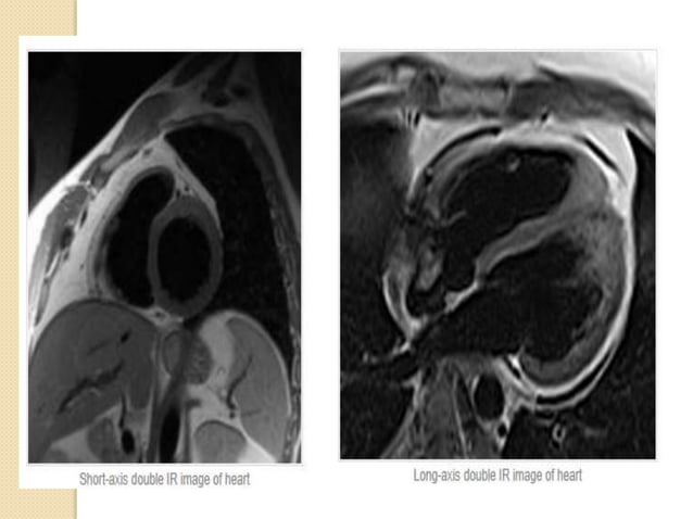 Cardiac MRI basics | PPTX