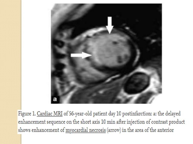 Cardiac MRI basics | PPTX