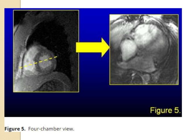 Cardiac MRI basics | PPTX