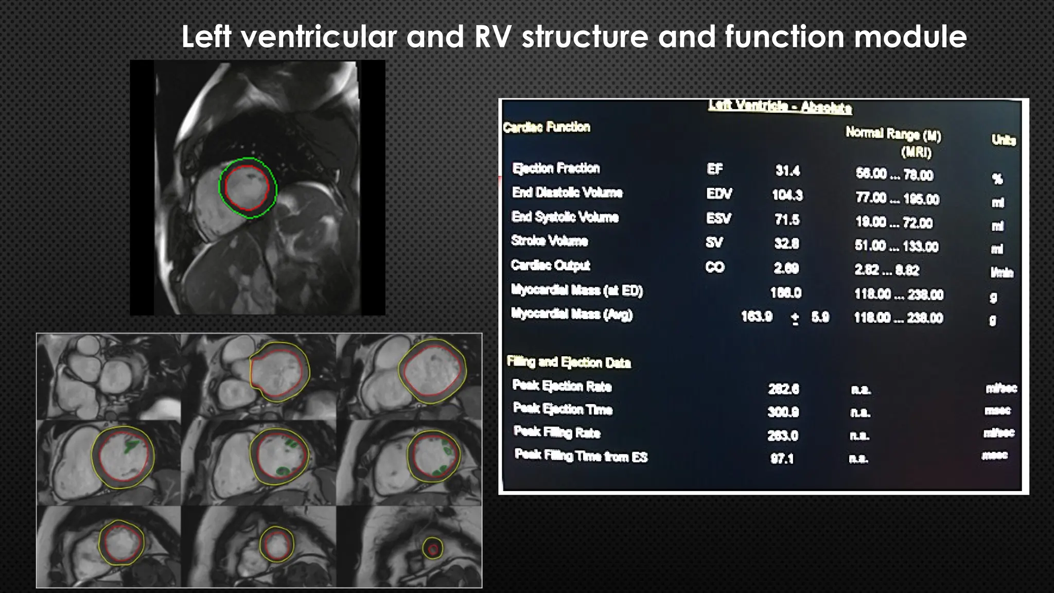 Cardiac MRI basics and interpretation.pptx