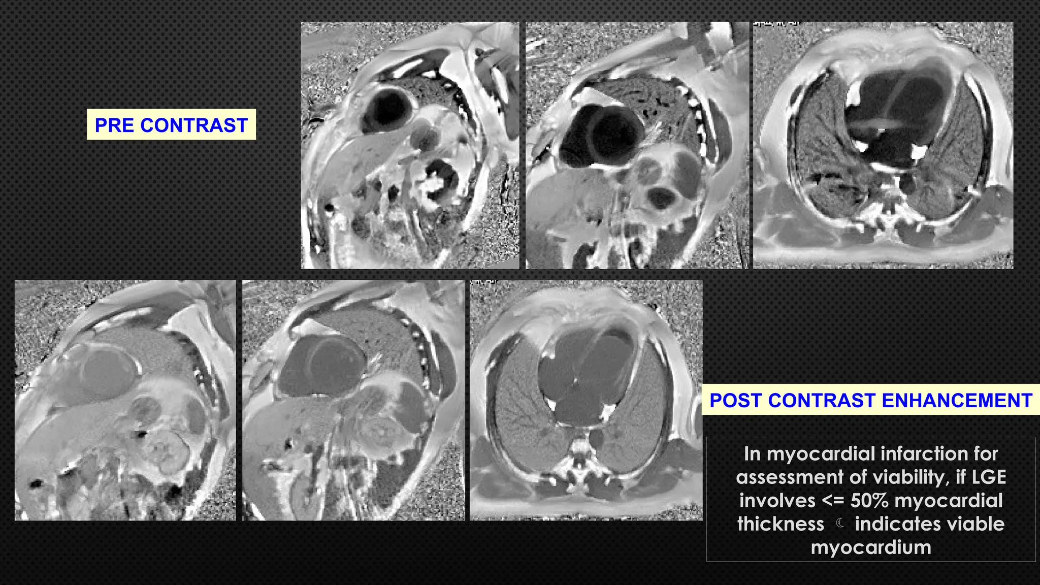 Cardiac MRI basics and interpretation.pptx