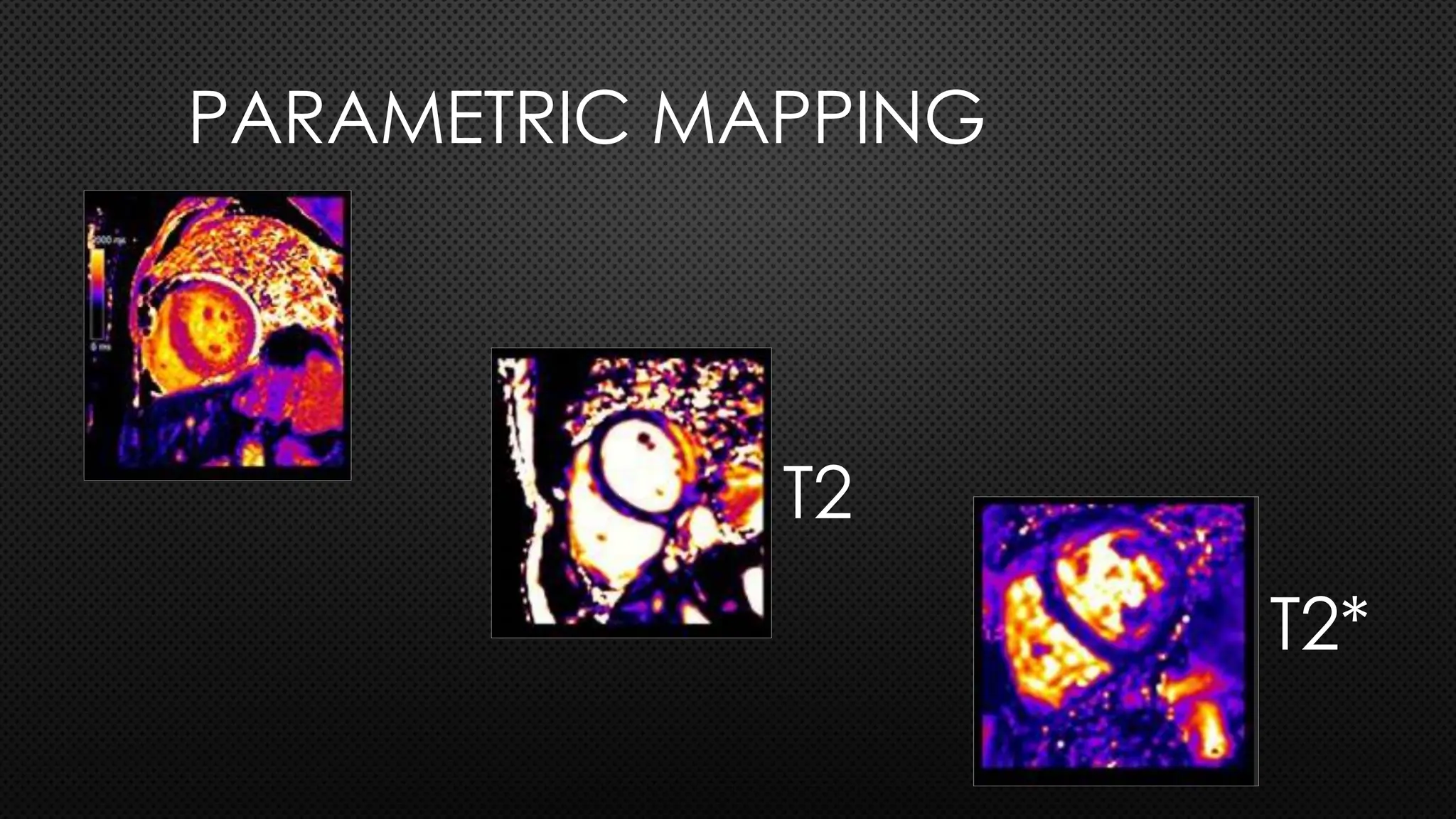 Cardiac MRI basics and interpretation.pptx