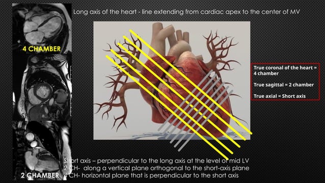 Cardiac MRI basics and interpretation.pptx