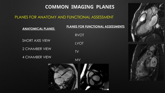 Cardiac MRI basics and interpretation.pptx