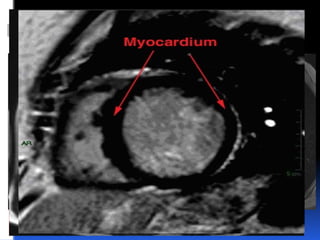 CARDIAC MRI PLANNING AND SEQUENCES .pptx