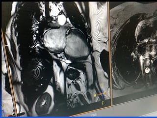 CARDIAC MRI PLANNING AND SEQUENCES .pptx