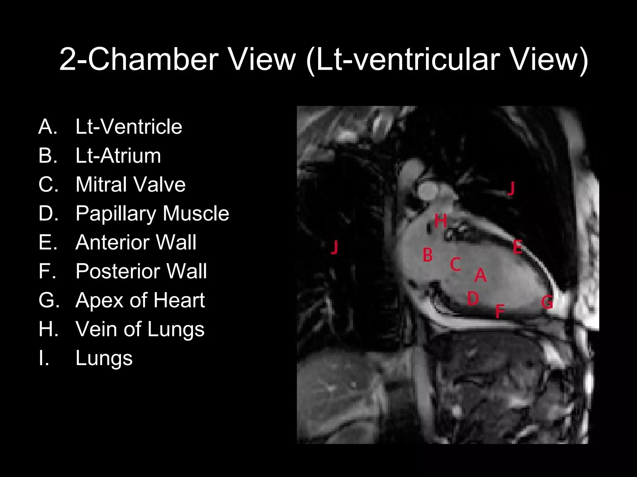 Cardiac mri&slice anatomy | PPT