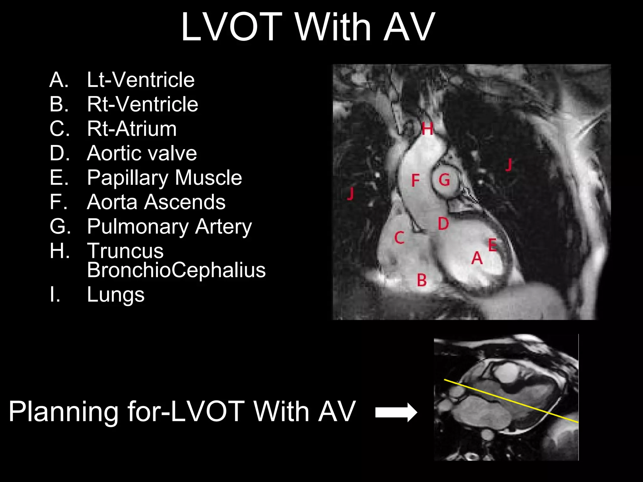 Cardiac mri&slice anatomy | PPT
