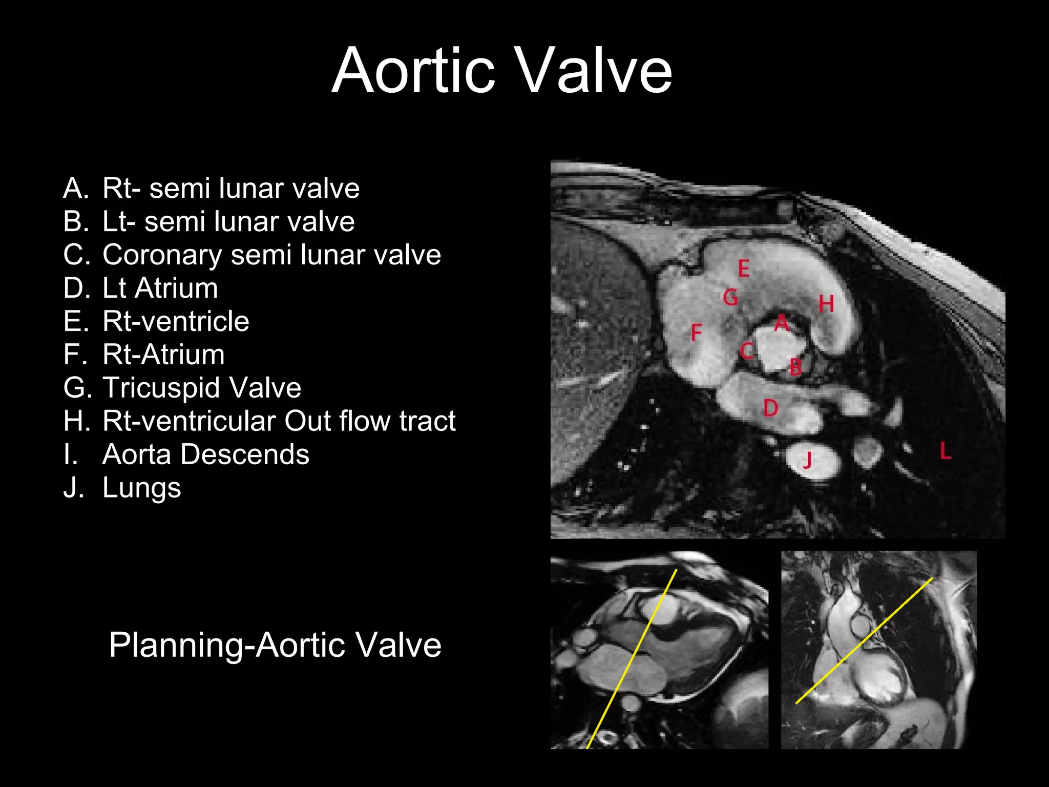 Cardiac mri&slice anatomy | PPT
