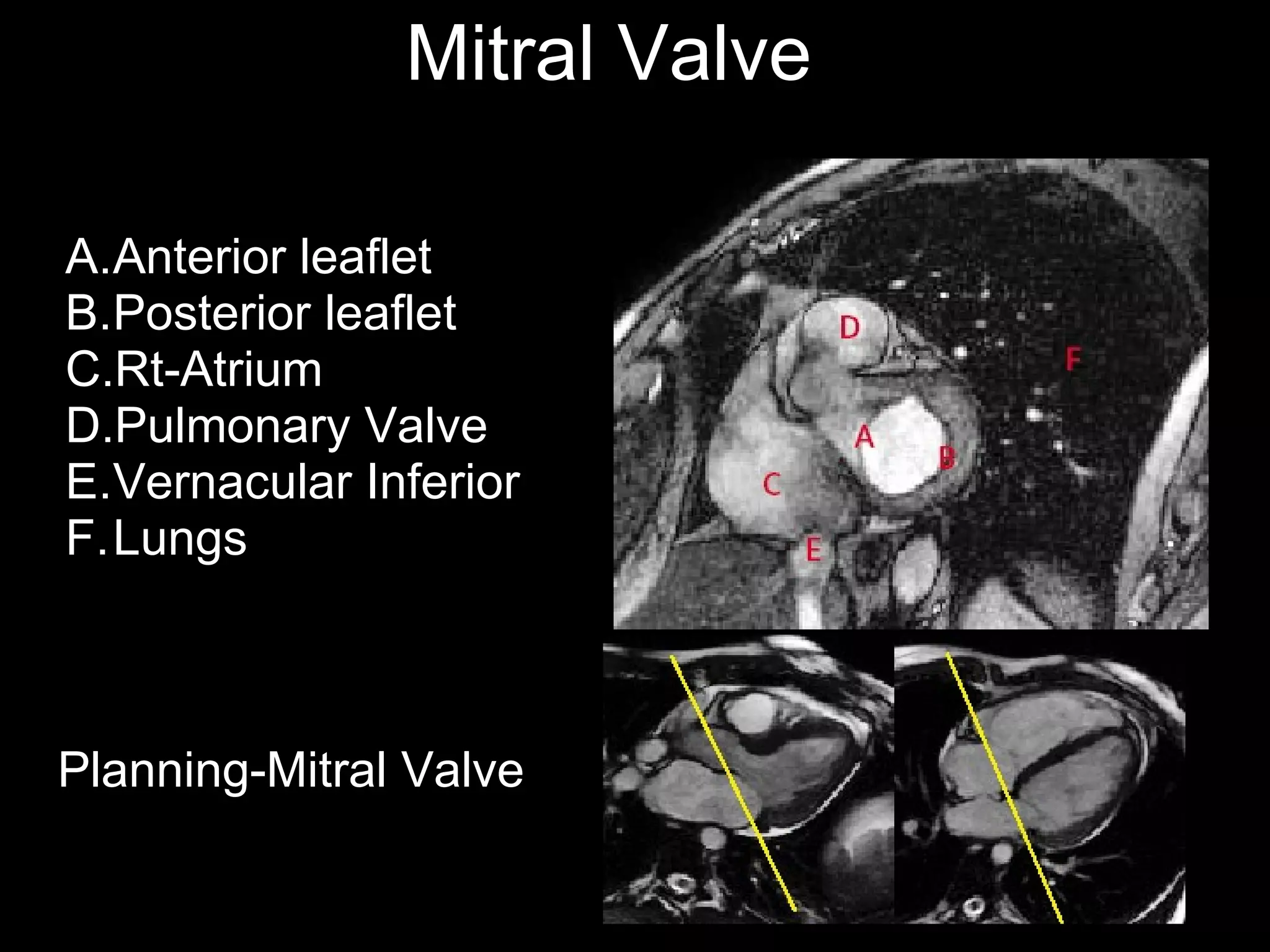 Cardiac mri&slice anatomy | PPT