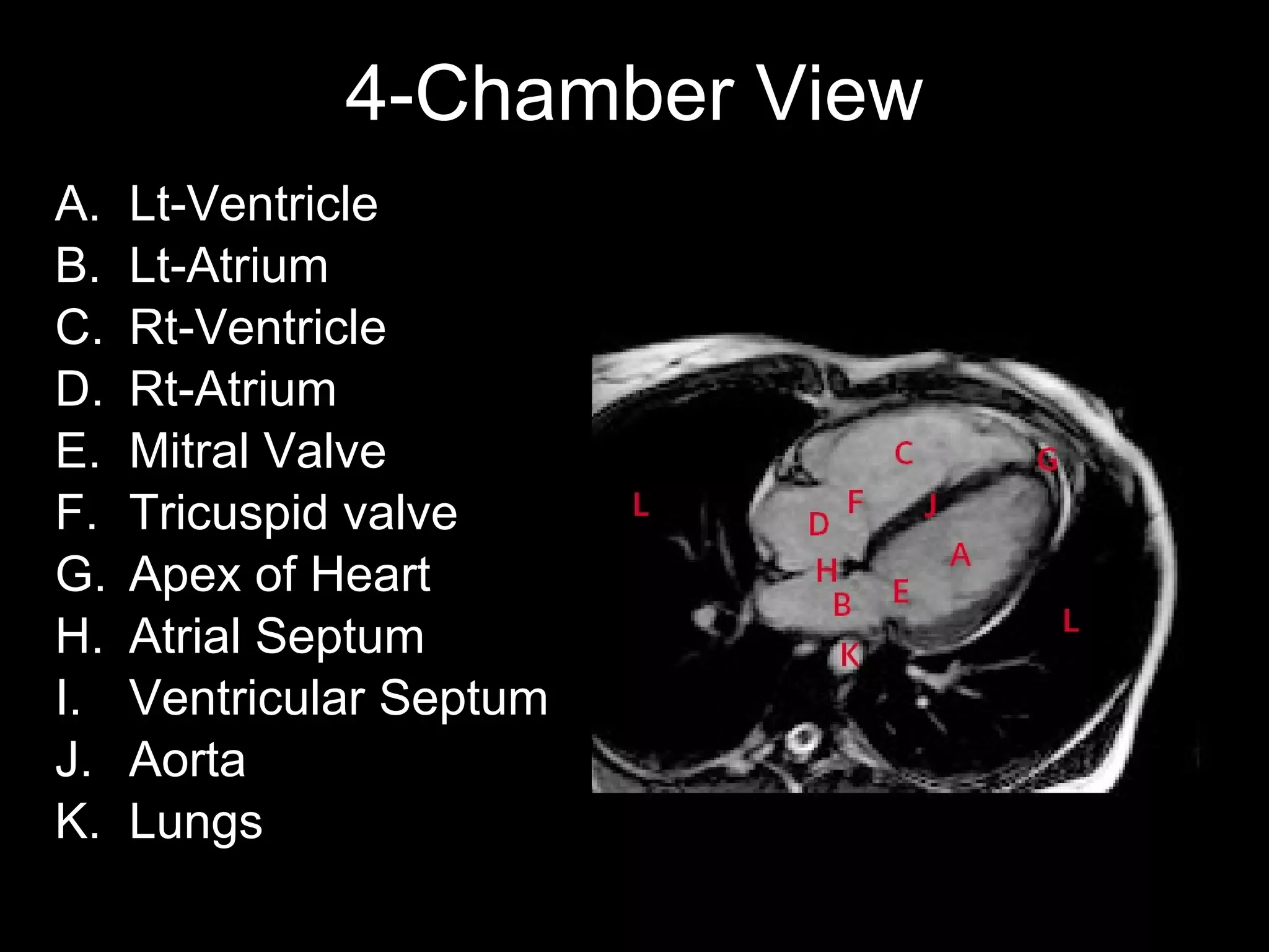 Cardiac mri&slice anatomy | PPT