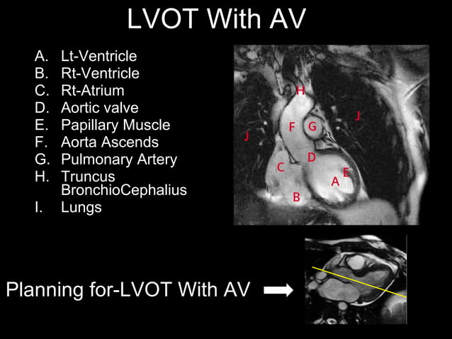 Cardiac mri&slice anatomy | PPT | Heart and Cardiovascular Diseases ...